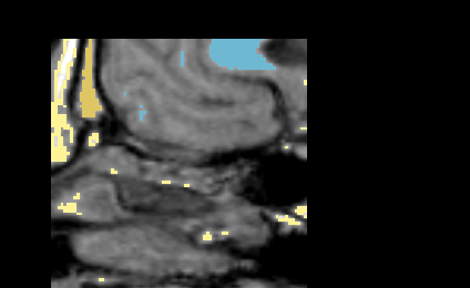 超级简单的3D slicer教程（三）creating label Map_3d slicer roi删除-CSDN博客