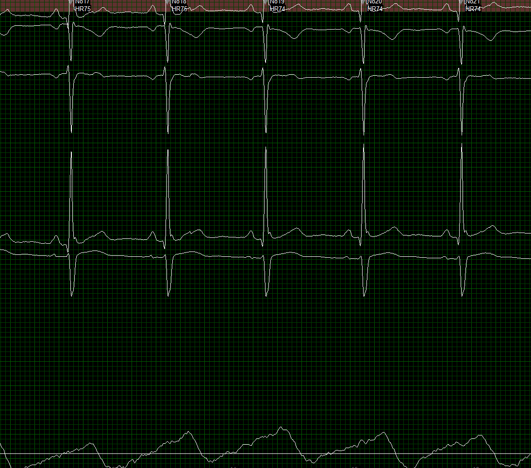 ADS1294R ECG+RESP-CSDN博客