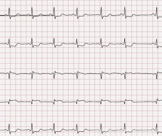 基于深度学习心电图（ECG）特征识别_ecg识别竞赛-CSDN博客