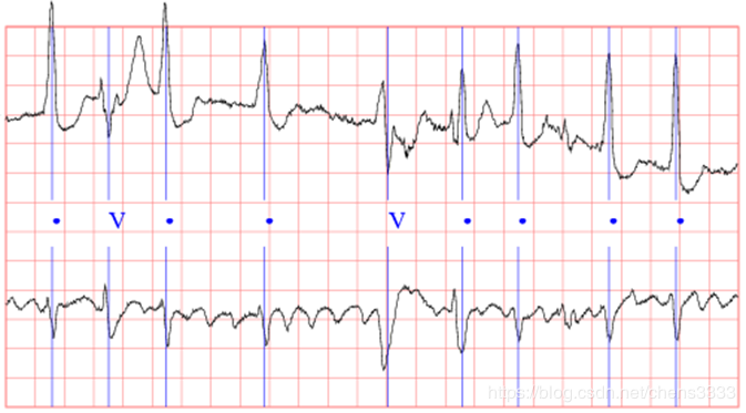 基于深度学习心电图（ECG）特征识别_ecg识别竞赛-CSDN博客
