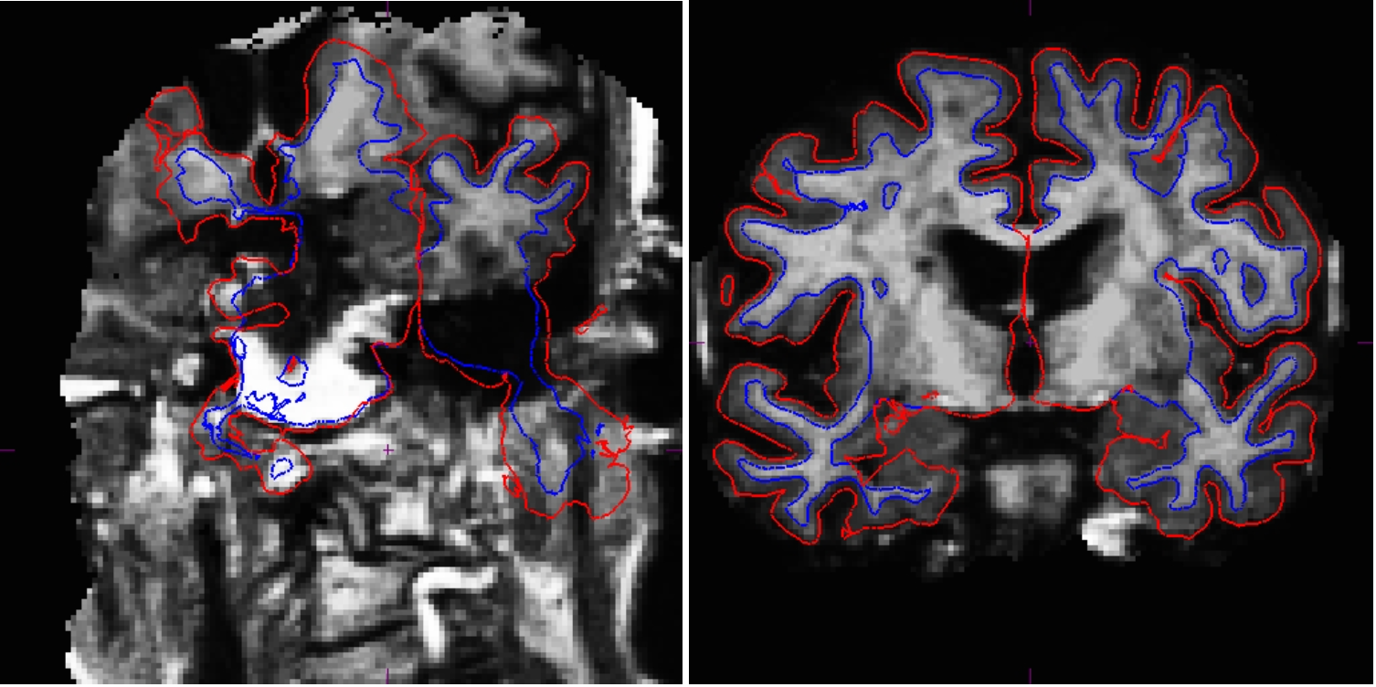 Freesurfer学习笔记——Longitudinal Tutorial 9/13_freesurfer 纵向数据-CSDN博客