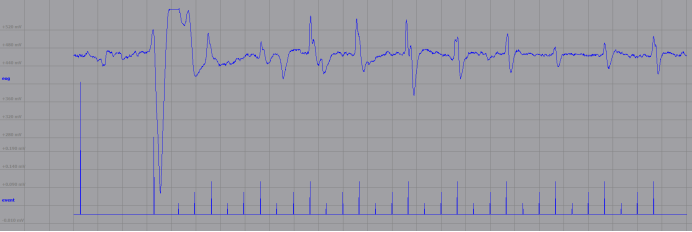 EOG眼电信号（眨眼检测）-CSDN博客