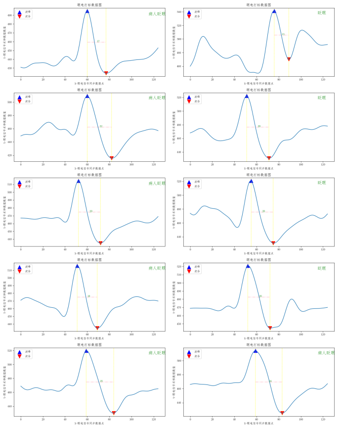 EOG眼电信号（眨眼检测）-CSDN博客