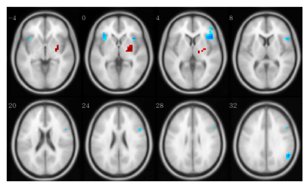 用xjview可视化fMRI分析结果-CSDN博客