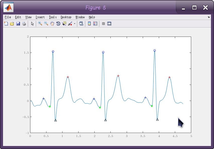 心电信号的PQRST模拟matlab代码(转载+自己调研汇总)-CSDN博客