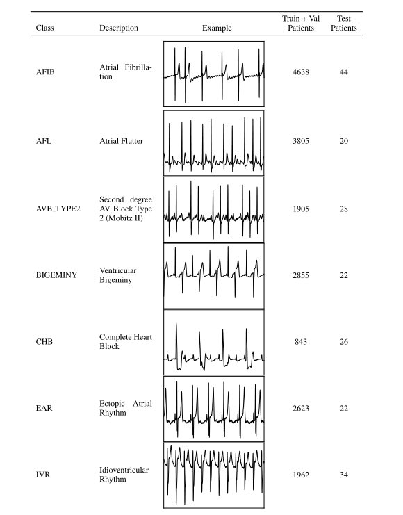 论文阅读：Cardiologist-Level Arrhythmia Detection with Convolutional Neural Networks_cardiologist ...