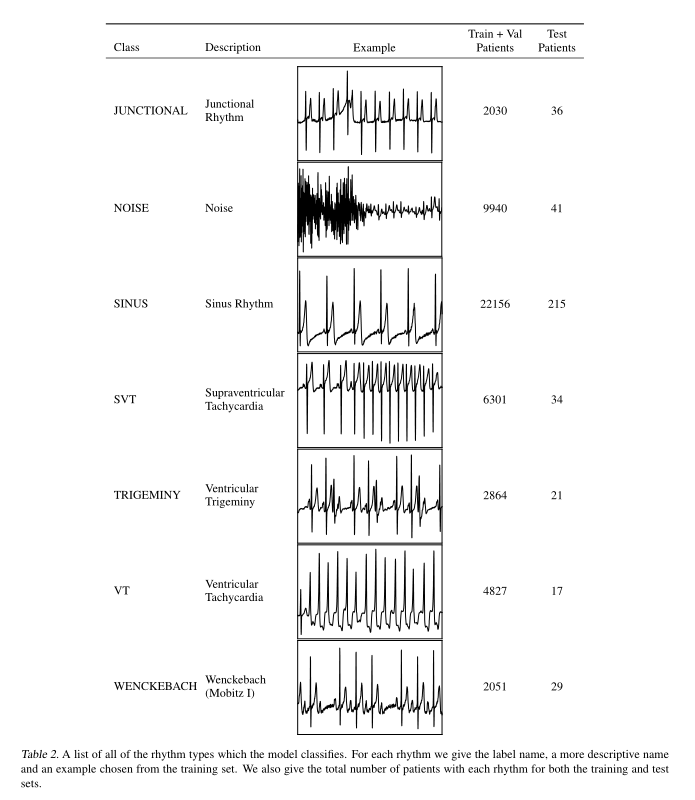 论文阅读：Cardiologist-Level Arrhythmia Detection with Convolutional Neural Networks_cardiologist ...
