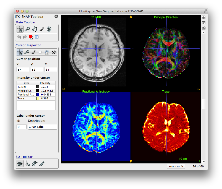 使用Voxelmorph配准IXI：数据预处理之颅骨去除及仿射对齐_对mri图像做仿射对齐是什么-CSDN博客