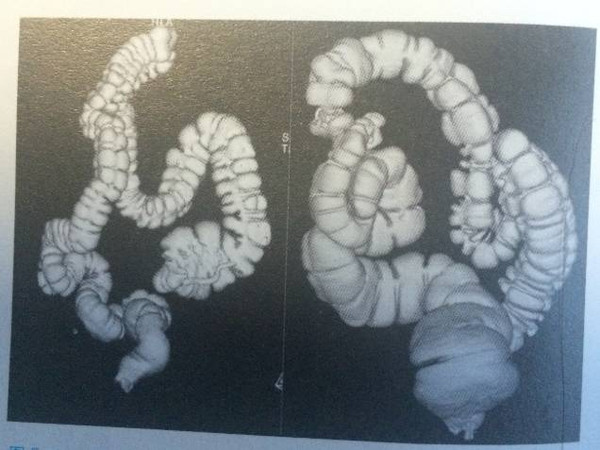CT三维重建基本后处理方法_ct ssd-CSDN博客