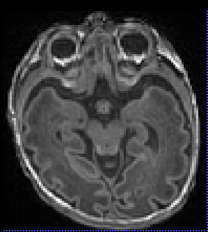 MRI脑图像处理-归一化：python,自适应归一化_mri图像归一化-CSDN博客