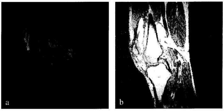 contrast-limited-adaptive-histogram-equalization-whcsrl