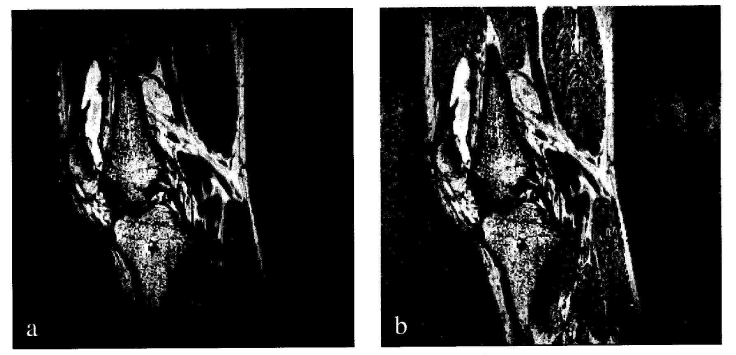《Contrast Limited Adaptive Histogram Equalization》自译-CSDN博客