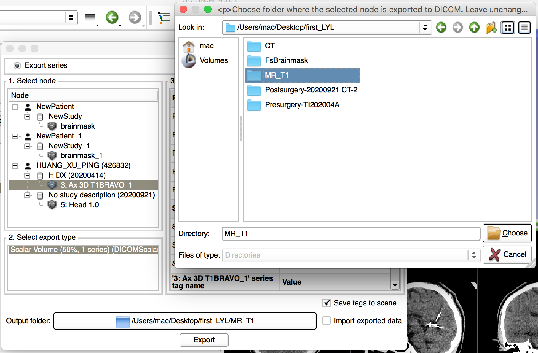实现SEEG电极触电的自动分割_slicer seeg-CSDN博客