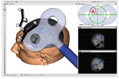 Robotic TMS（一）：TMS（经颅磁刺激）介绍_tms线圈-CSDN博客
