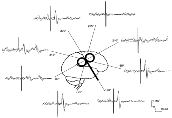 Robotic TMS（一）：TMS（经颅磁刺激）介绍_tms线圈-CSDN博客