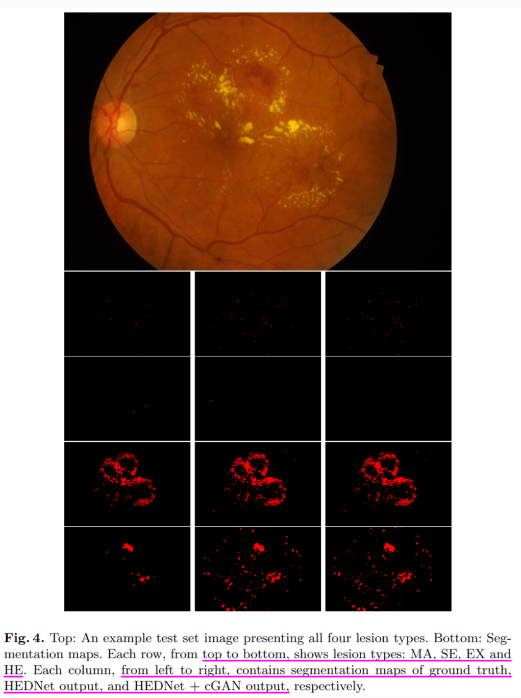 Improving Lesion Segmentation for Diabetic Retinopathy using ...
