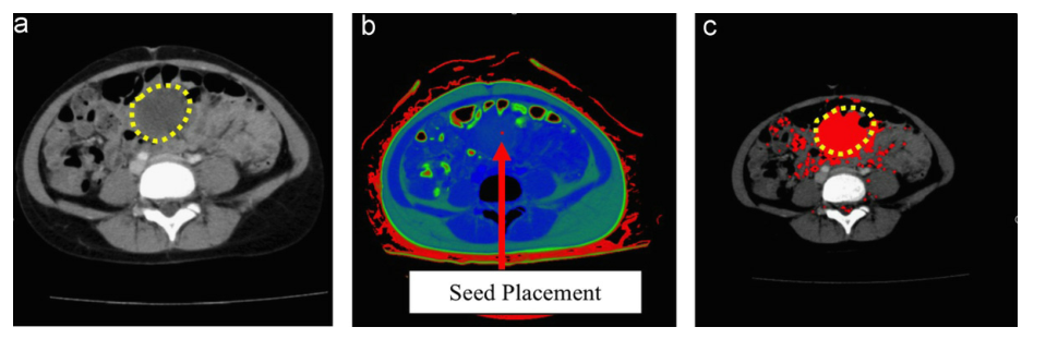 医学图像彩色化相关--20201208论文笔记Colorization of CT images to improve tissue ...