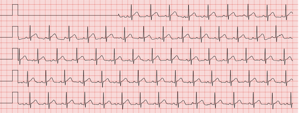 小波变换在心电图ECG中的应用_小波变换心电图-CSDN博客