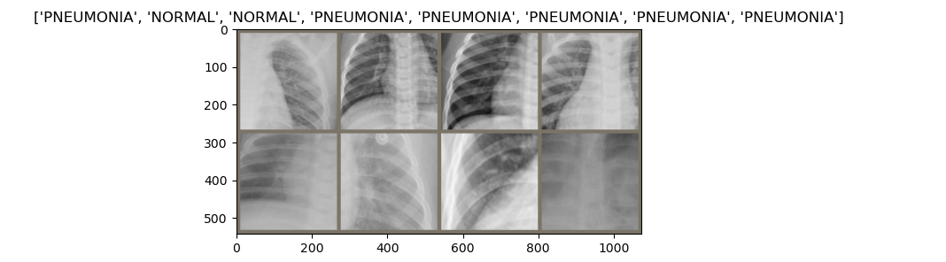 pytorch入门基础（二）肺部感染识别案例-1_pytorch chest x-ray-CSDN博客