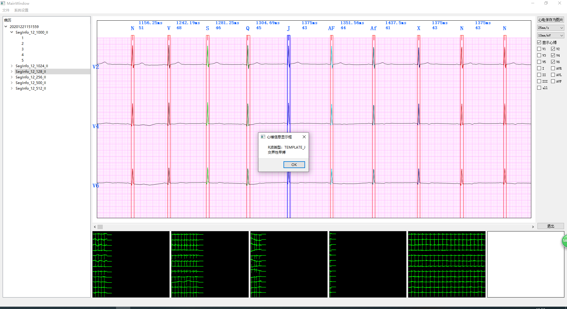 Qt开发之心电显示项目实现_qcustomplot 心电图-CSDN博客
