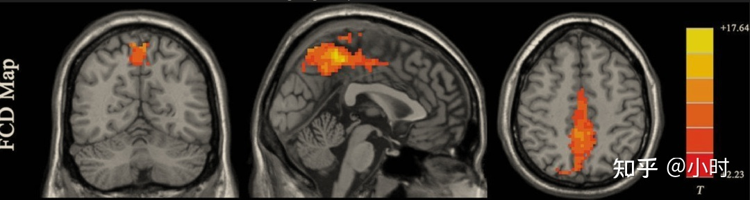 脑机接口专栏 | 如何分析静息状态的fMRI数据？（三）_fmri脑网络单一分析-CSDN博客
