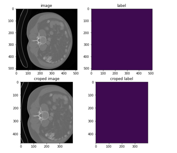MONAI(4)—一文看懂各种Transform用法（下）_randcropbyposneglabeld-CSDN博客