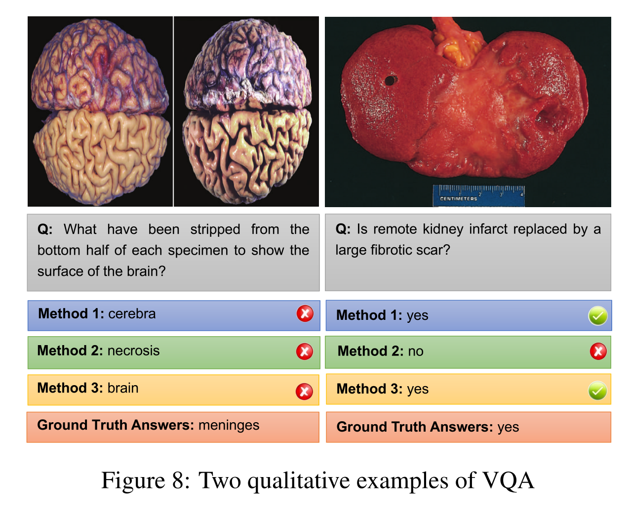 【VQA文献阅读】PATHVQA: 30000+ QUESTIONS FOR MEDICAL VISUAL QUESTION ANSWERING-CSDN博客