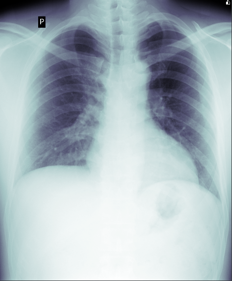 pydicom提取DICOM胸片图像_胸片影响特征提取-CSDN博客