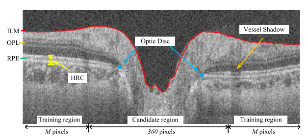 Automatic Optic Disc Detection in OCT Slices via Low-Rank ...