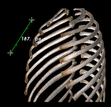 VTK 长度测量和角度测量 vtkDistanceWidget vtkAngleWidget vtkBiDimensionalWidget-CSDN博客