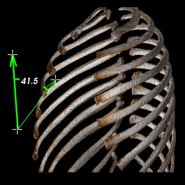VTK 长度测量和角度测量 vtkDistanceWidget vtkAngleWidget vtkBiDimensionalWidget-CSDN博客