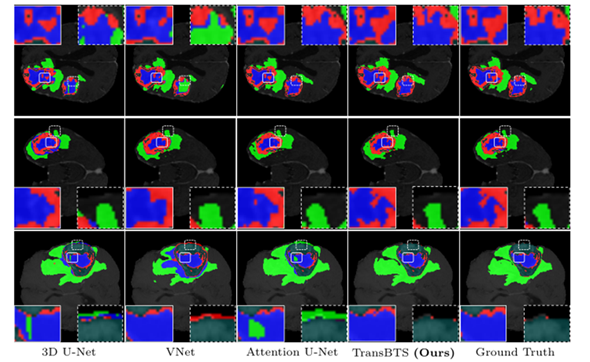 [深度学习论文笔记] TransBTS: Multimodal Brain Tumor Segmentation Using Transformer 基于Transformer的多模态脑肿瘤 ...