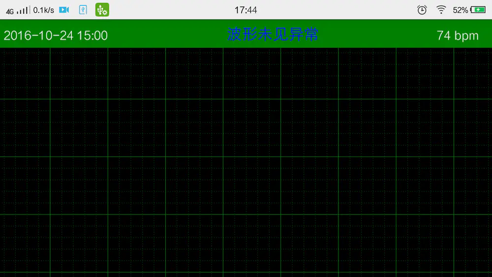 android 开发 心电图绘制_android画心电图-CSDN博客