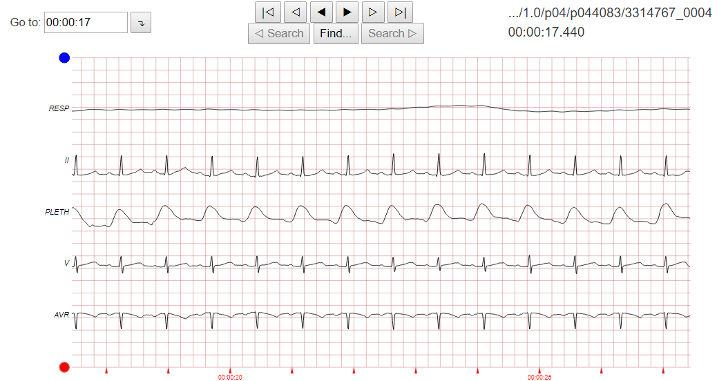 【MIMICIII应用】（一）MIMICIII波型数据库说明_mimic-iii waveform database matched subset-CSDN博客