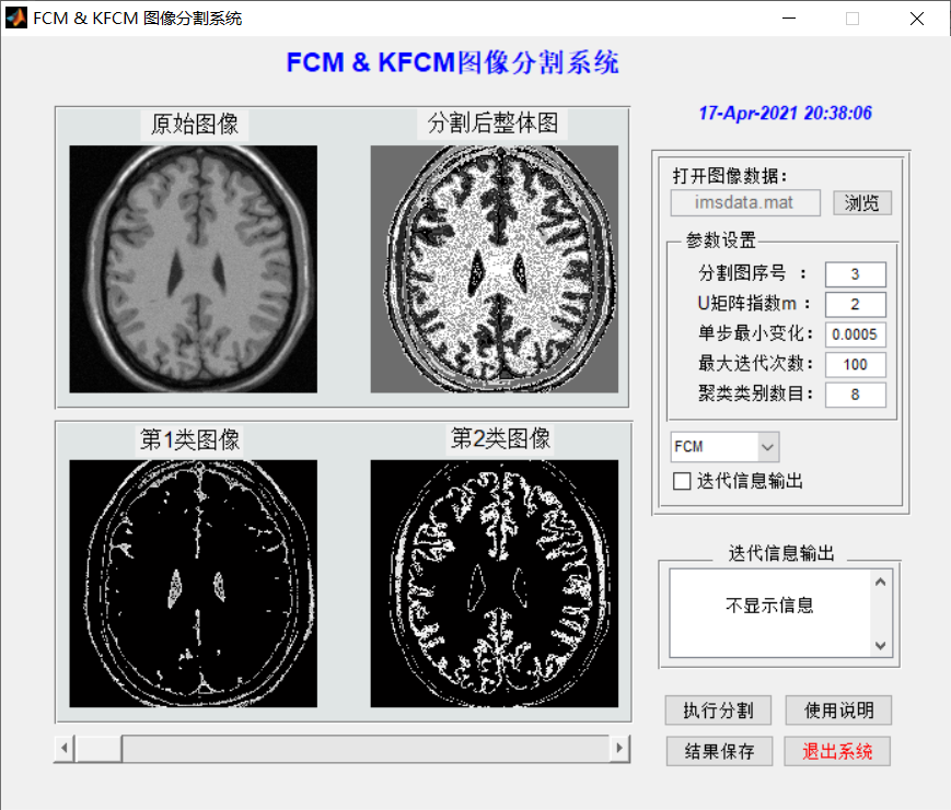 【图像分割】基于FCM和KFCM算法医学图像分割matlab源码含GUI_matlab基于pso-kfcm的医学图像分割方面的-CSDN博客