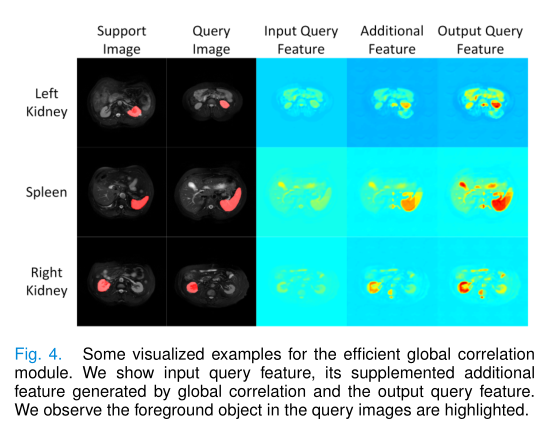 [医学小样本分割]Few-shot Medical Image Segmentation using a Global Correlation Network with ...