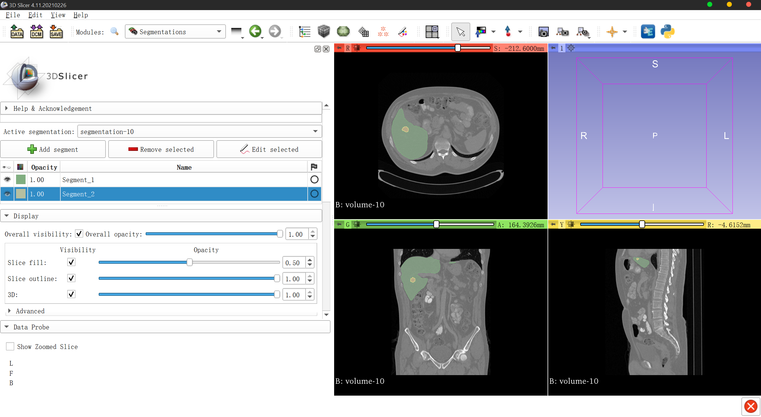 【深度学习笔记】3D Slicer三维可视化_3d slicer如何显示立体画面-CSDN博客