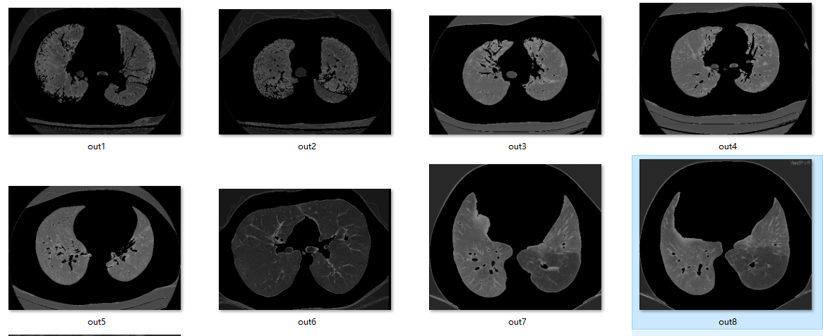 Matlab 批量CT图像进行肺实质分割_ct图能做实物分割吗-CSDN博客