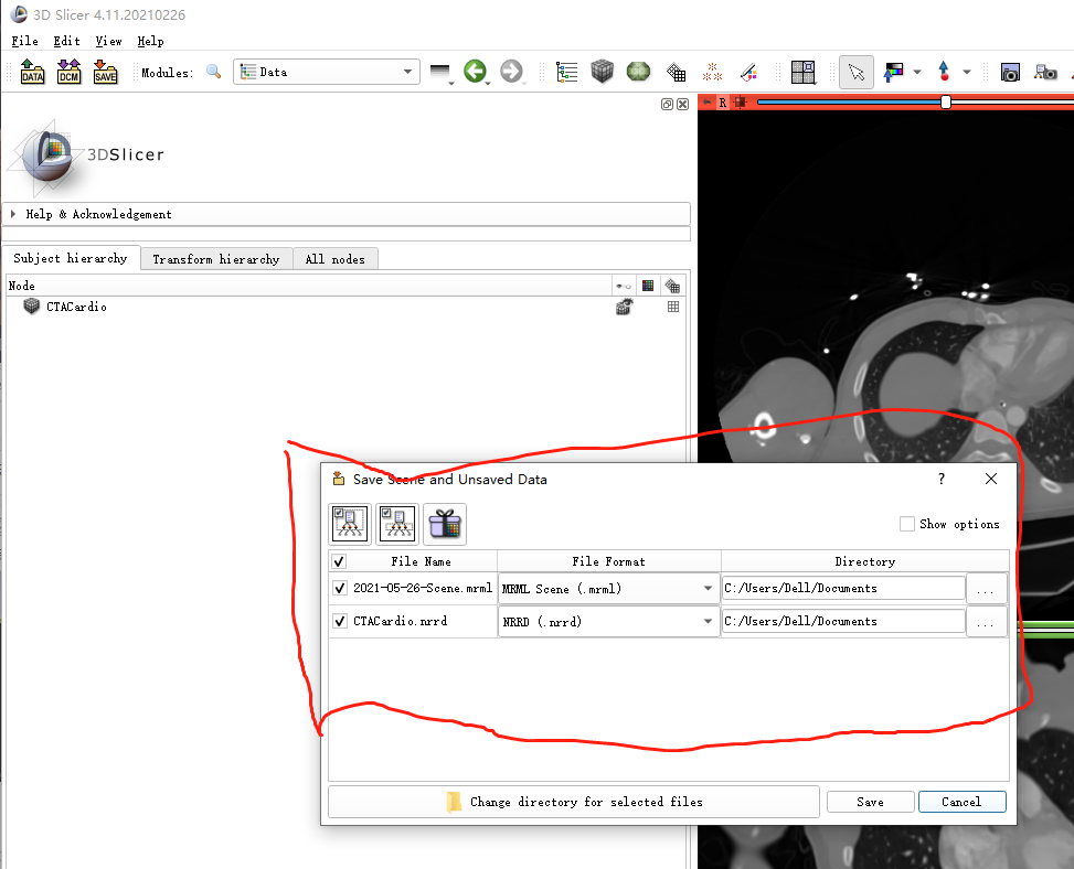 3D slicer分割器官的步骤简介（一）_3dslicer肌肉的阈值-CSDN博客