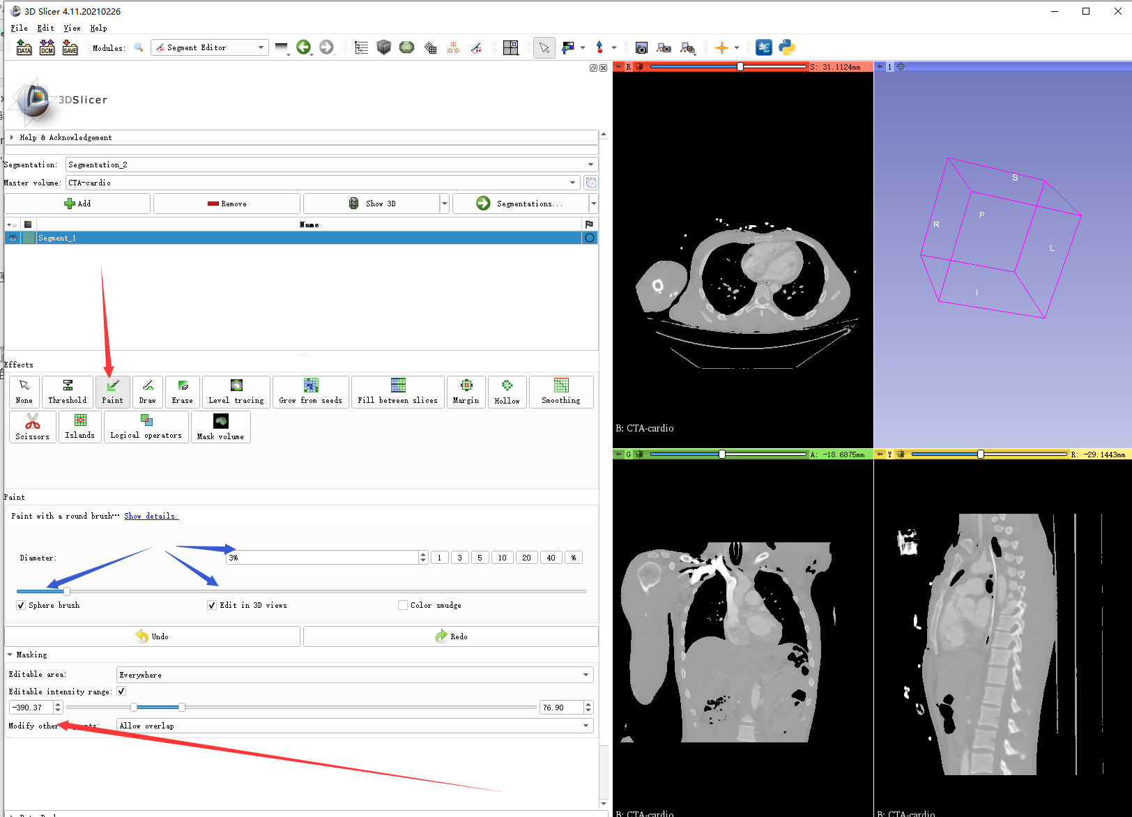 3D slicer分割器官的步骤简介（一）_3dslicer肌肉的阈值-CSDN博客