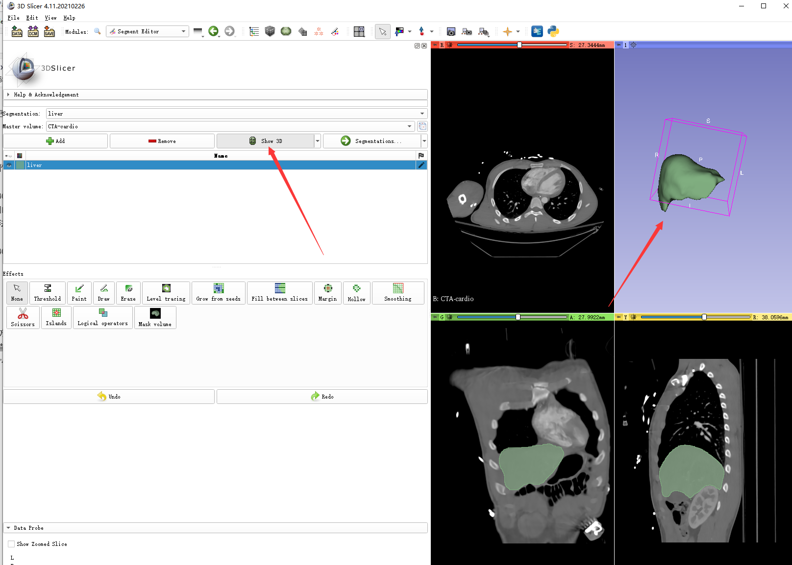 3D slicer分割器官的步骤简介（一）_3dslicer肌肉的阈值-CSDN博客