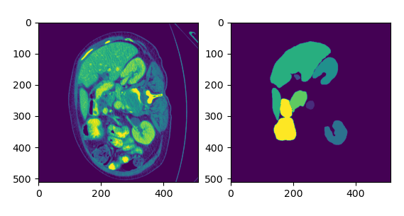 TransUNet阅读笔记与训练尝试_.npy.h5-CSDN博客