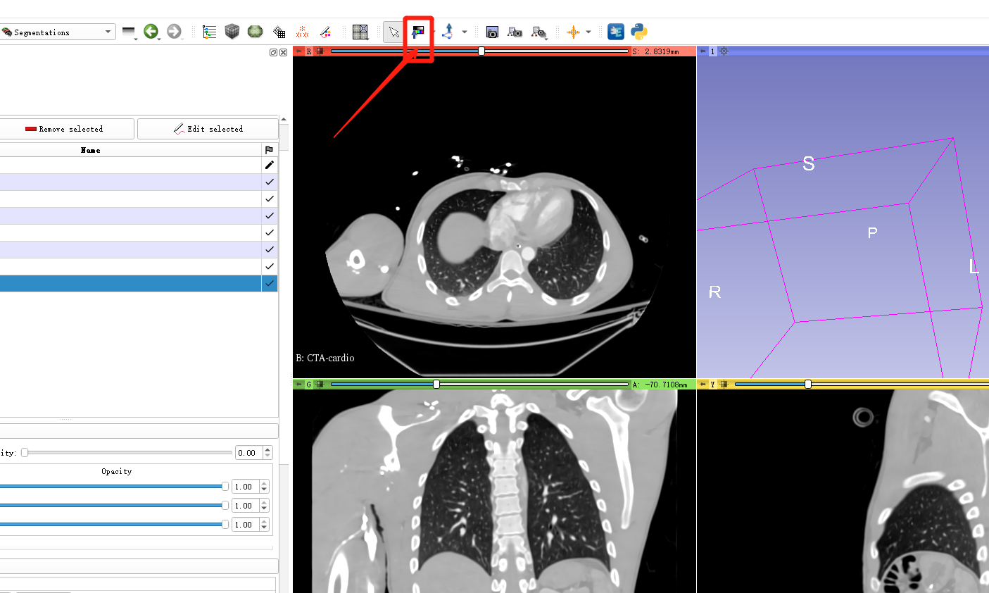 3D slicer分割器官的步骤简介（一）_3dslicer肌肉的阈值-CSDN博客
