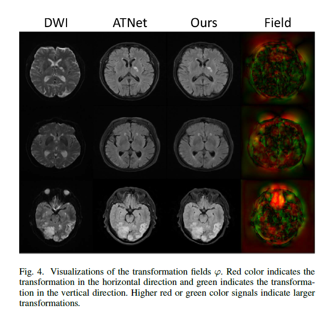 Deep Learning Based Registration文章阅读(十一)《A Coarse-to-fine Deformable ...