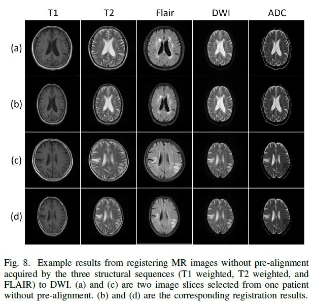 Deep Learning Based Registration文章阅读(十一)《A Coarse-to-fine Deformable ...