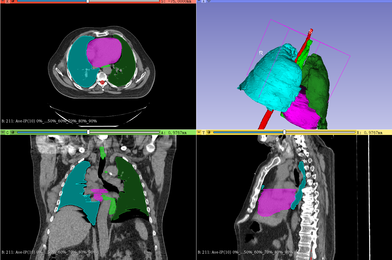 医疗图像深度学习——打开DICOM文件的RT STRUCT 标记图像并转化为图片_tcia转图片-CSDN博客