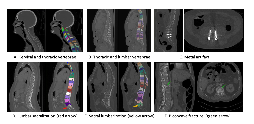 论文阅读：CTSpine1K：A Large-Scale Dataset for Spinal Vertebrae Segmentation ...