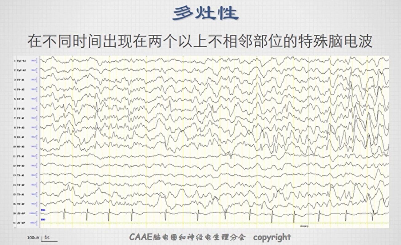 第三课：脑电图波形的分析和识别_脑电图波形解读-CSDN博客