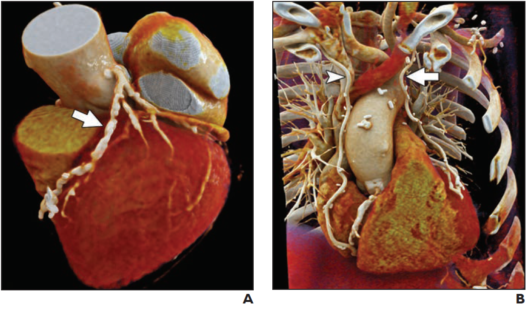 电影渲染技术cVRT在CT中的应用：一种新的逼真的3D可视化技术_cinematic rendering-CSDN博客