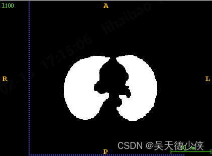 使用python简单实现肺分割（其实精度还可）_python肺实质分割-CSDN博客